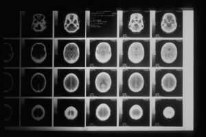 Organic Brain Damage: Causes, Symptoms, and Treatments